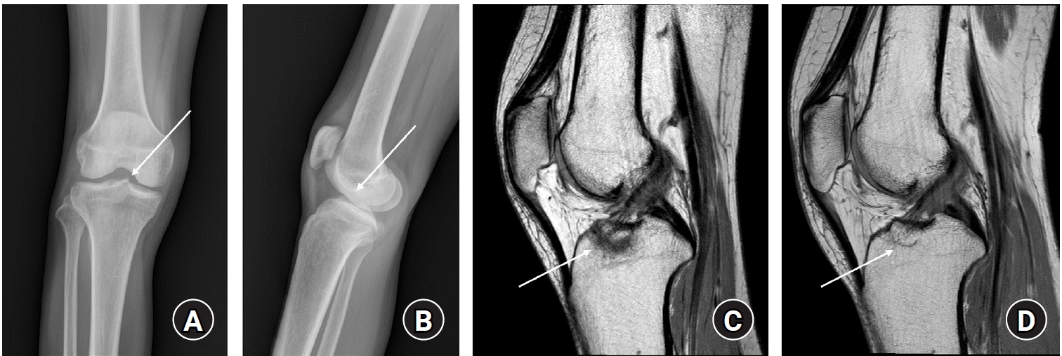 Avulsion Fractures Radiology